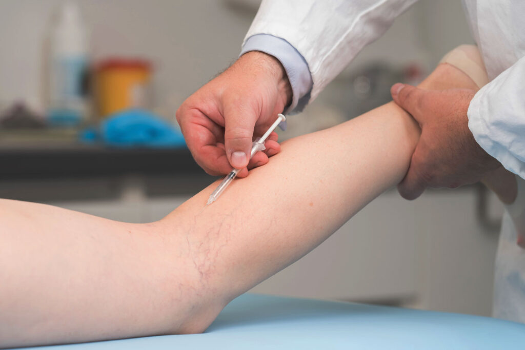 Radiofrequency Ablation - Atallah Vascular Center